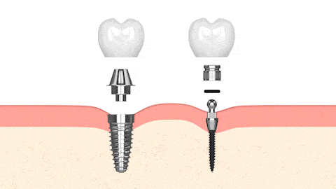 Implantes convencionales vs Mini Implantes Dentales | Dr. Brandon Hall