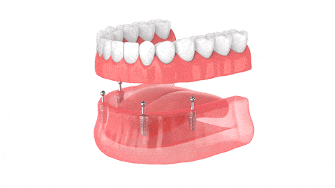 Implant-Retained Denture Process | Mini Dental Implants in Austin